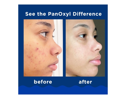 PanOxyl Maximum Strength Acne Foaming Wash 5.5 oz (2-pk)